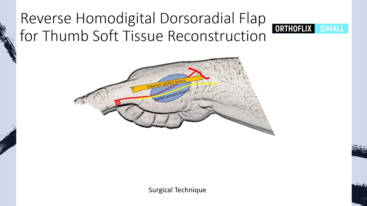 Reverse Homodigital Dorsoradial Flap for Thumb Soft Tissue ...