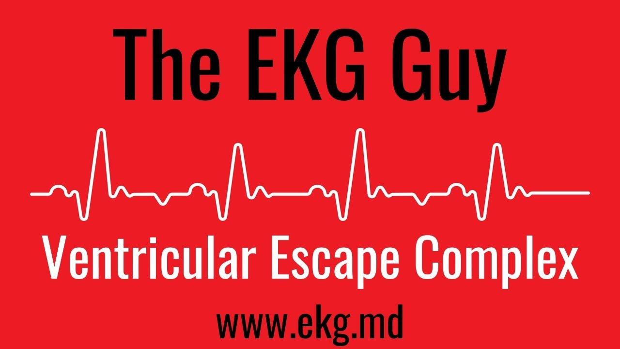 Ventricular Escape Complex EKG l The EKG Guy - www.ekg.md - YouTube