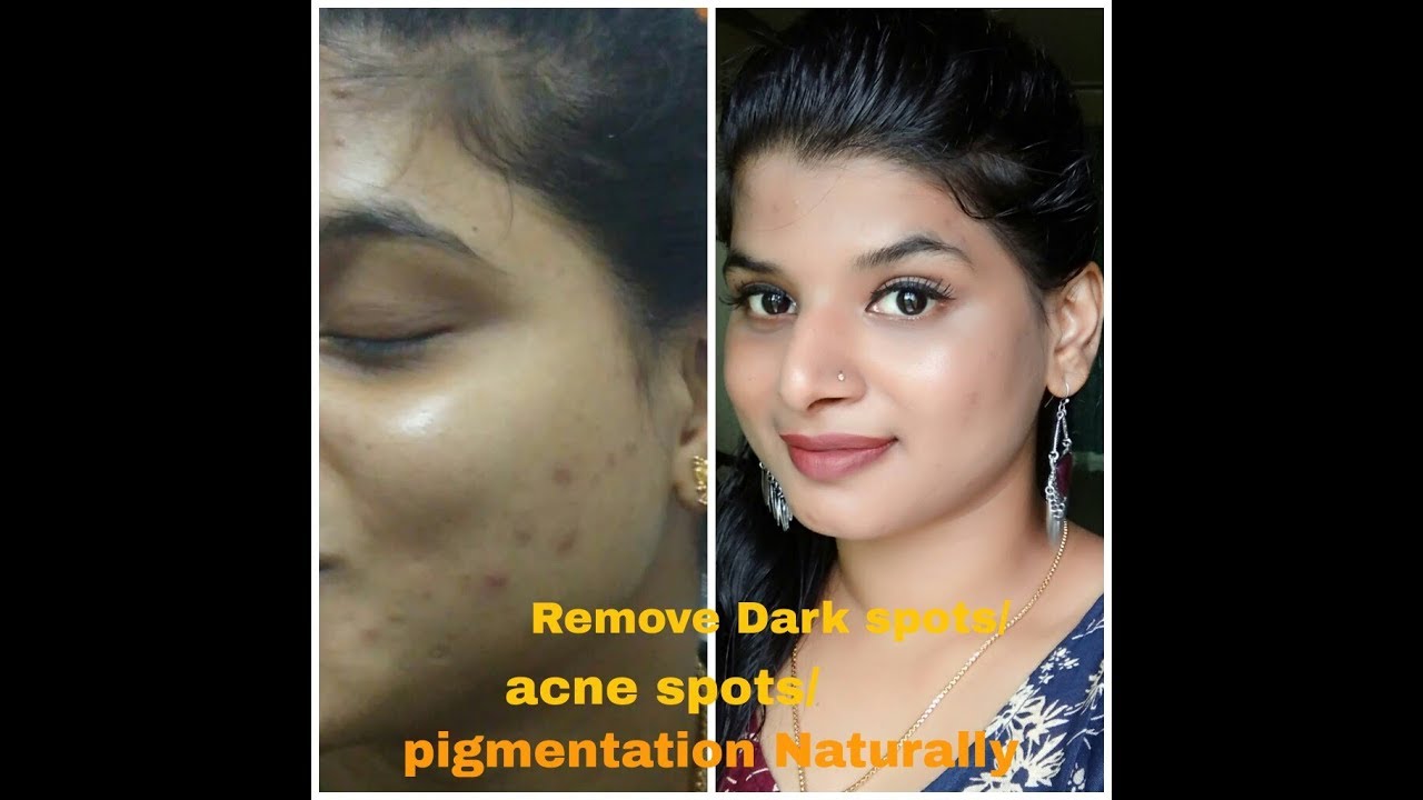 How to remove Dark spots, acne spots and pigmentation Naturally - YouTube
