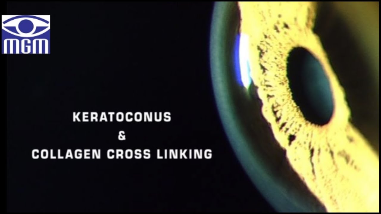Keratoconus and Corneal Collagen Cross Linking (CXL) || MGM Eye ...