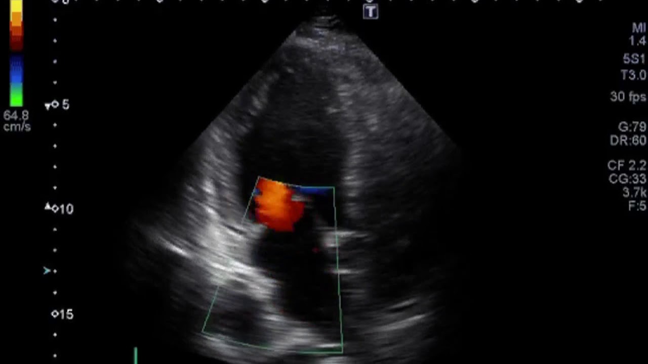 Cardio2012-ECG374-07- MR evaluation - YouTube