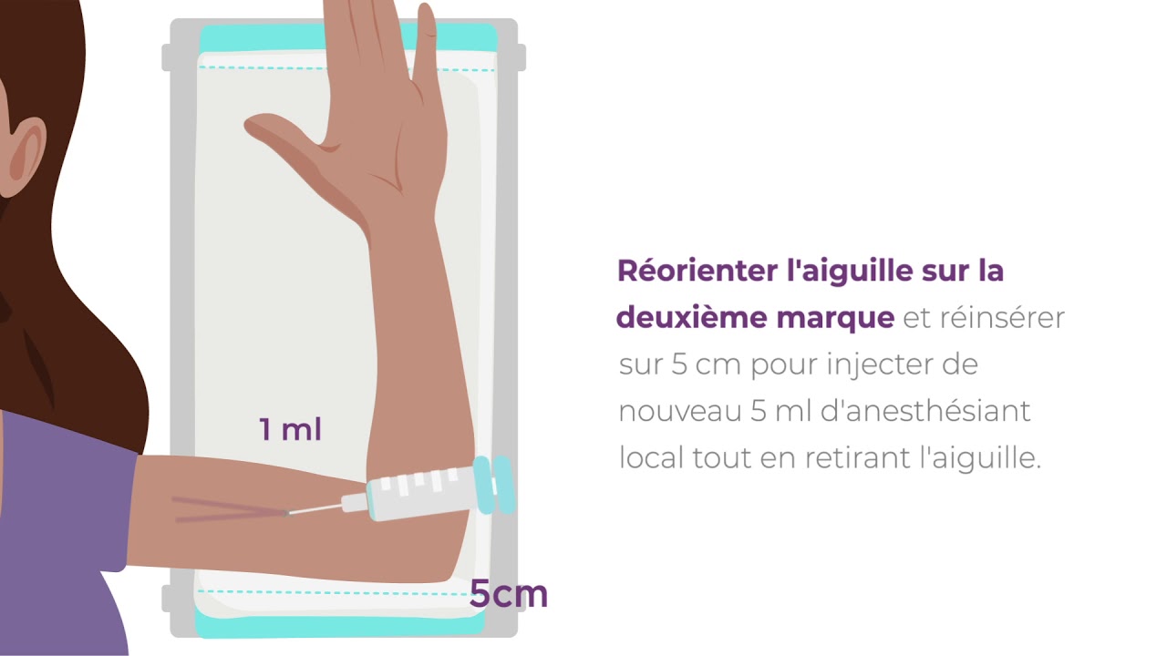 Comment insérer les implants Levoplant™ ? [ANCIENNE VERSION] Version ...