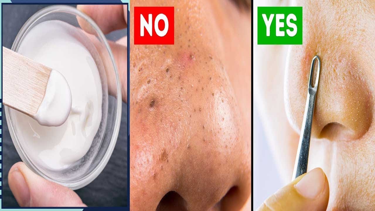 How to remove blackhead from face and nose simply with toothpaste - YouTube