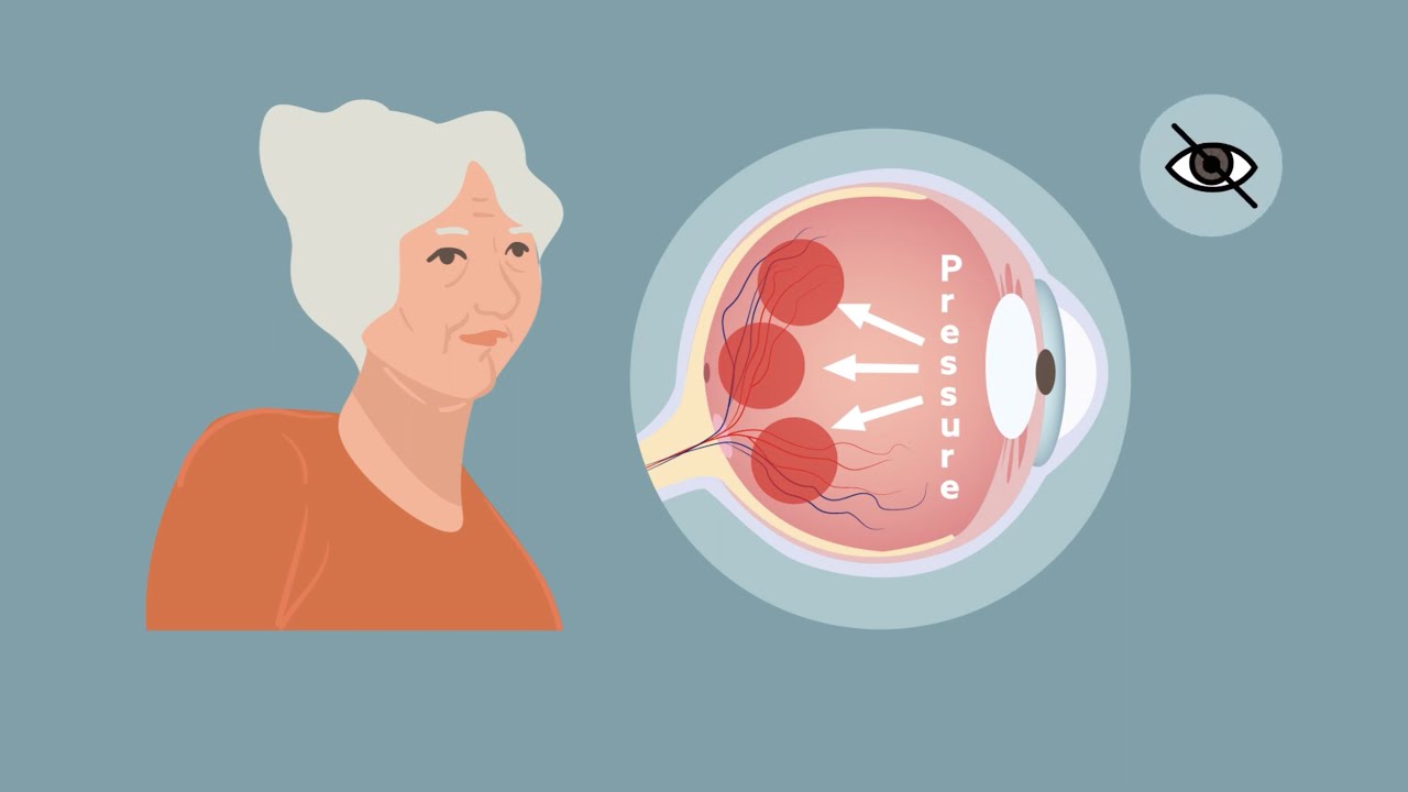 Improve Glaucoma Management with the RETeval Handheld ERG Device - YouTube