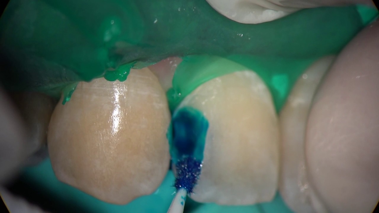 Indirect Pulp Capping & Direct Bonding -Day 1- - YouTube