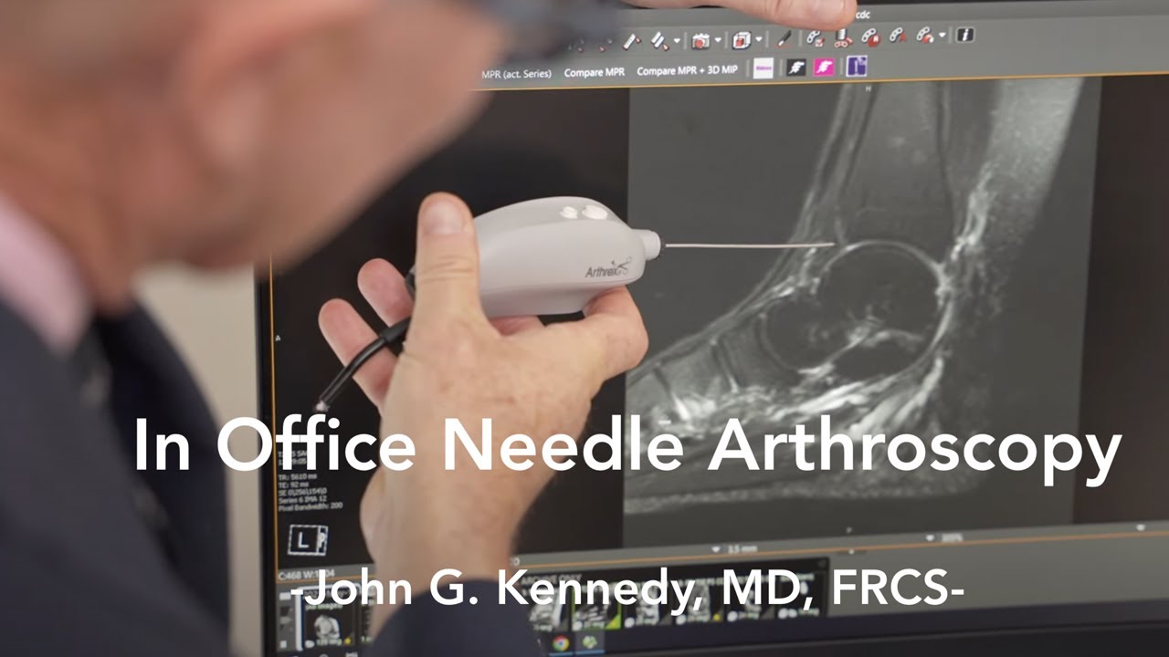 In-Office Needle Arthroscopy - YouTube