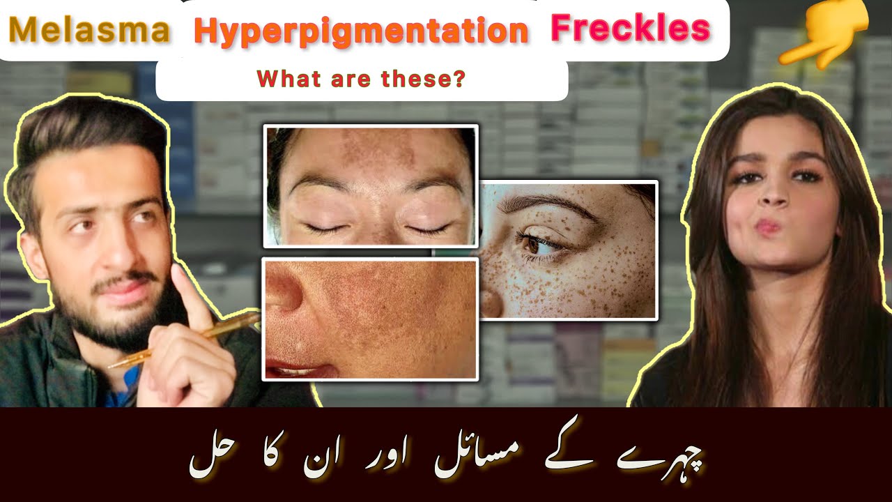 Melasma | Hyperpigmentation | Freckles |It’s Causes and Treatment ...