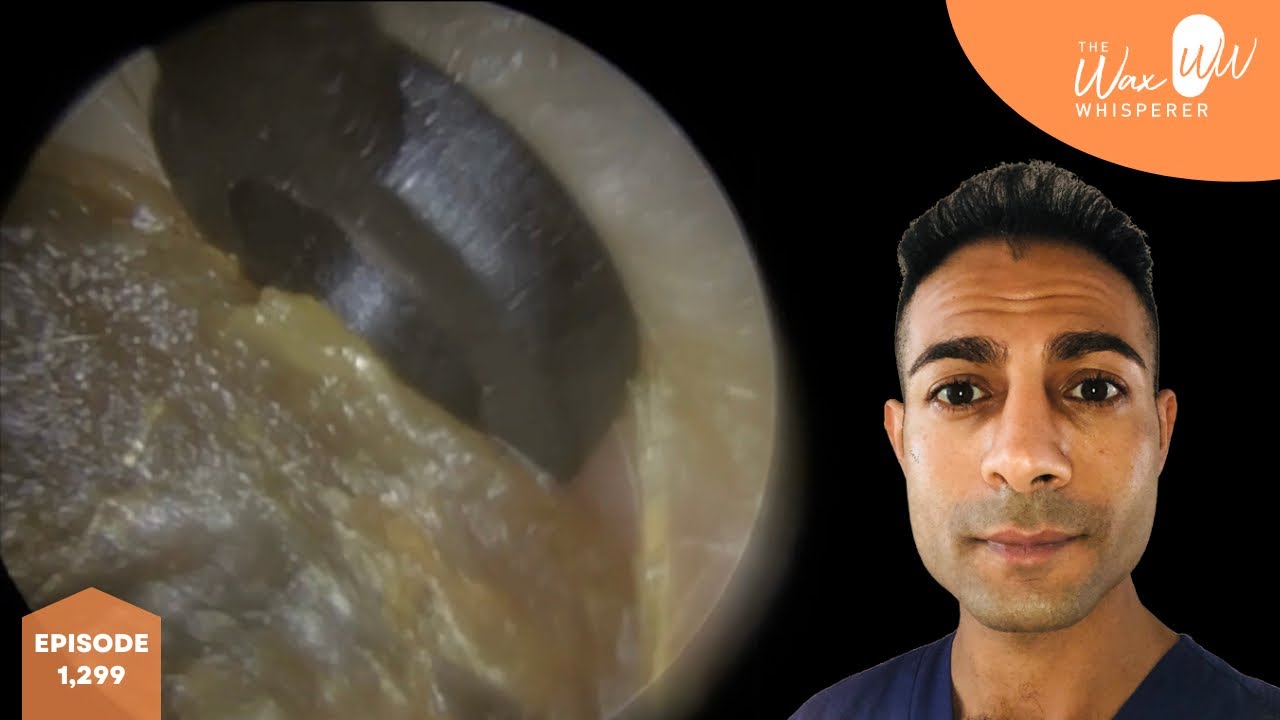 1,299 - Ear Hook & Jobson Horne Ear Wax Removal - YouTube