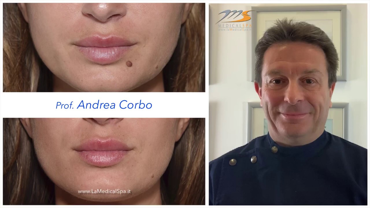 Asportazione di un Nevo del viso con Laser CO2 - YouTube