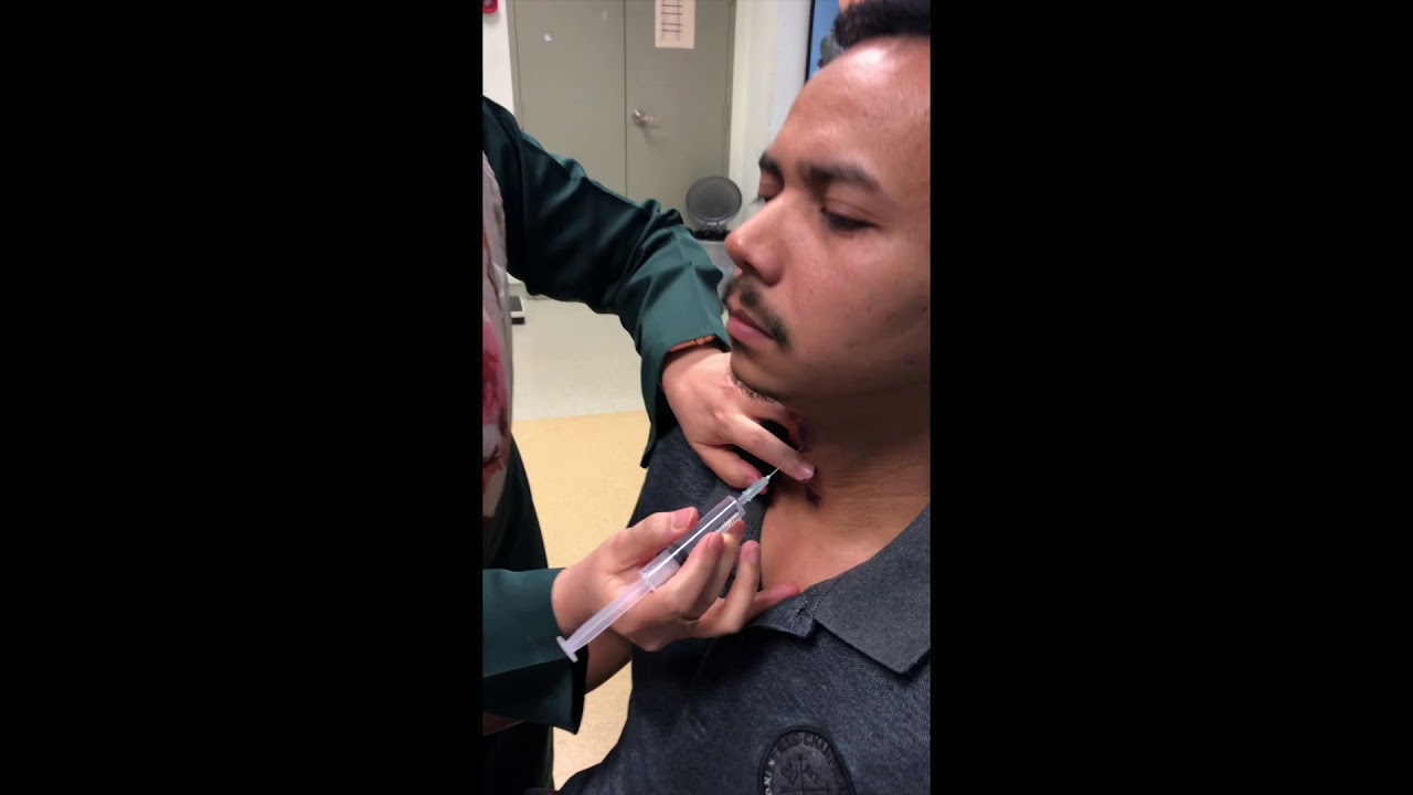 Percutaneous transthyrohyoid Botox injection to the larynx for adductor ...