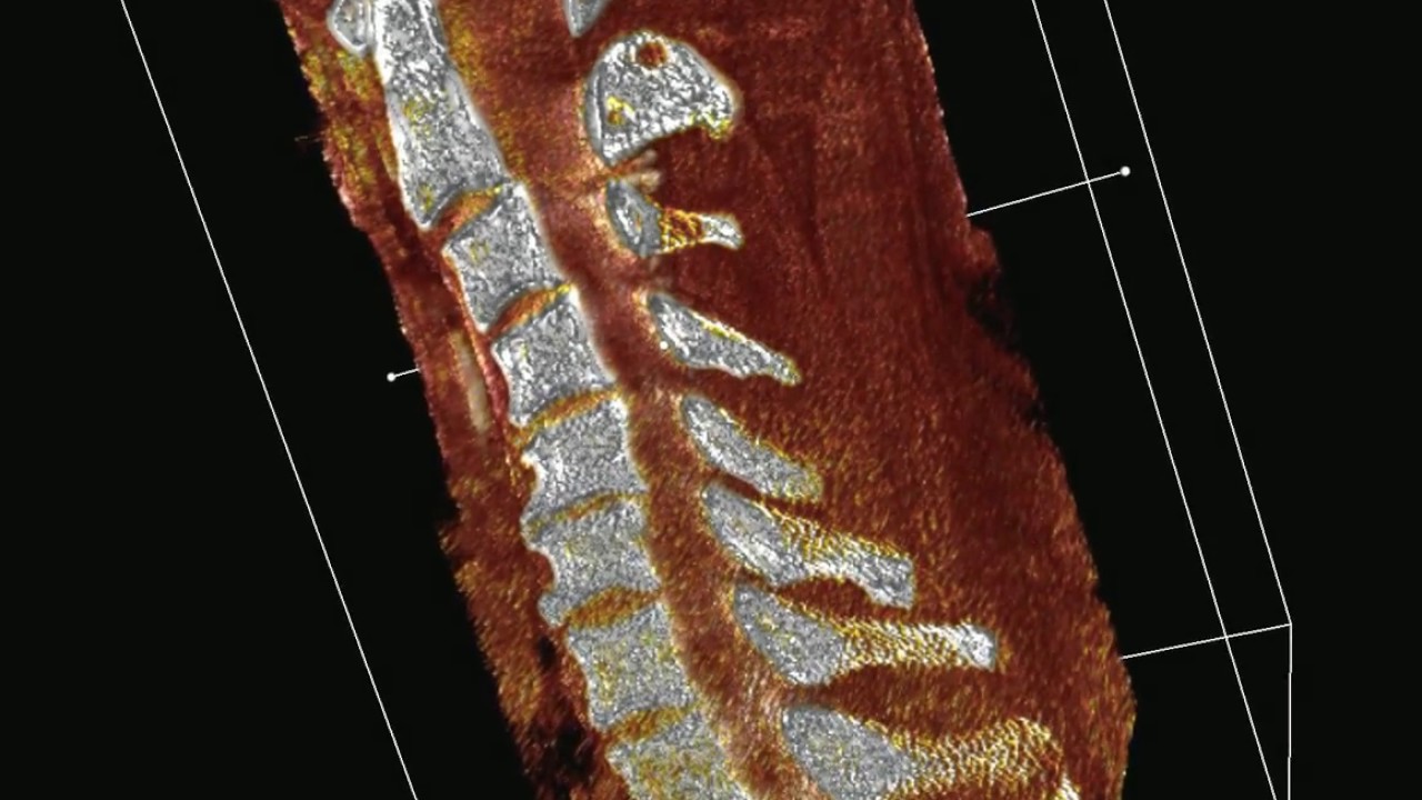 Cervical Disc(C5-6) Degeneration - YouTube