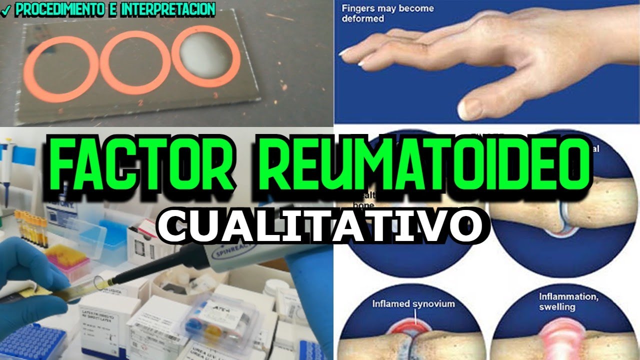 An lisis Cualitativo Del Factor Reumatoideo Gu a Pr ctica En Placa