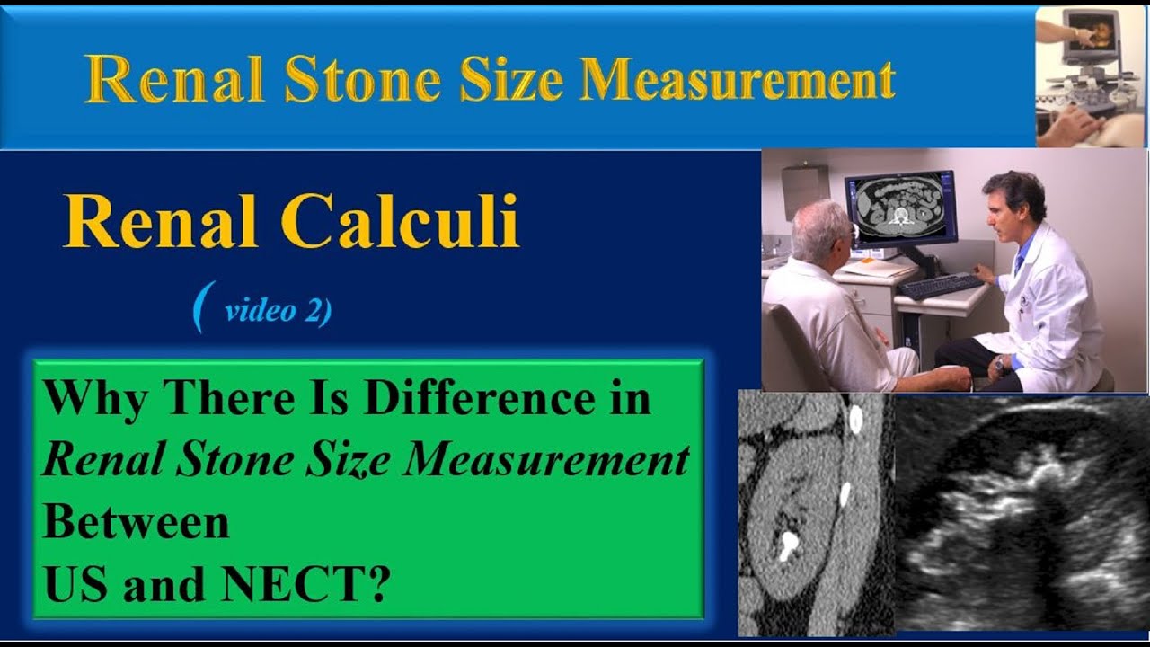 Renal stone Ultrasound: Renal Stone Size Measurement - YouTube