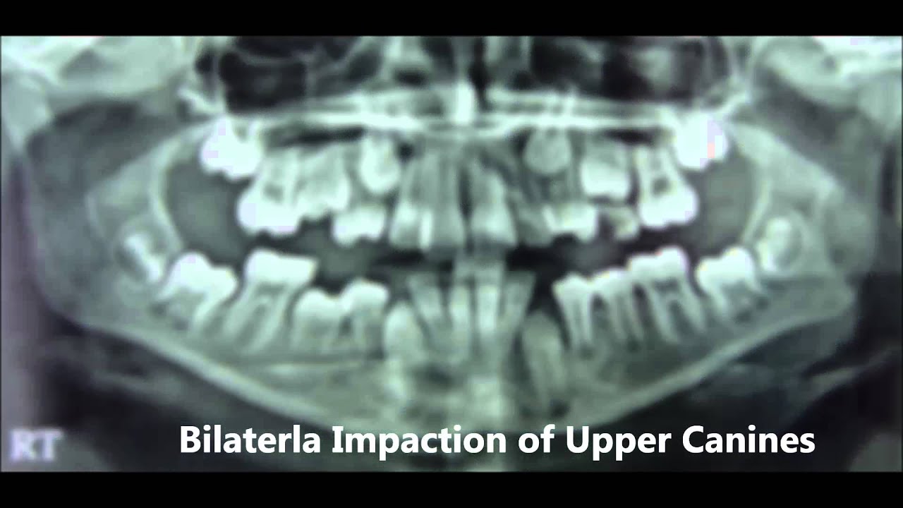 Non-Extraction Treatment of Bilateral Impaction of Upper Canines - Dina ...