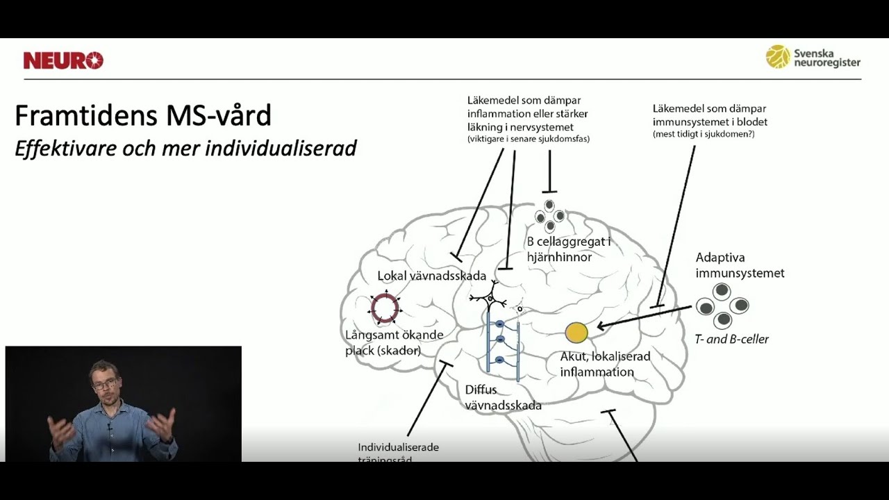 Senaste nytt om diagnosen multipel skleros, MS - Ta del av Neuros ...