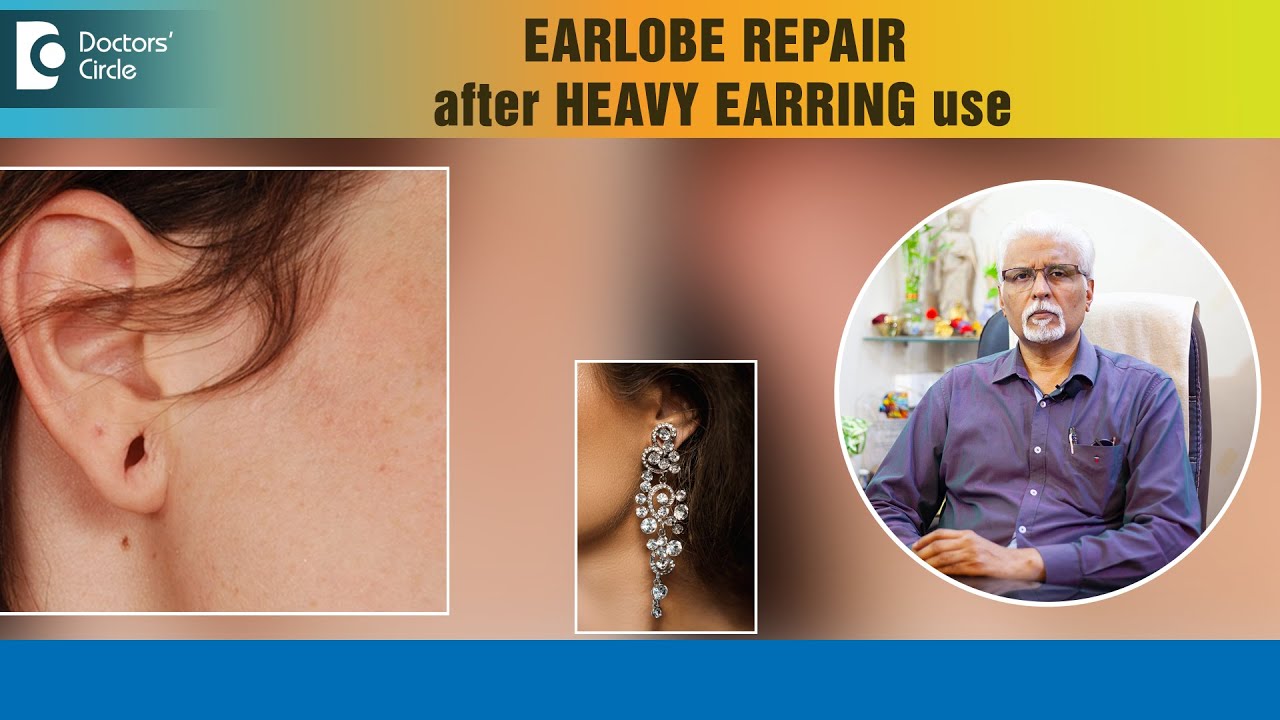 TORN EARLOBE After Heavy Earring | Fix EAR TEAR | Earlobe Repair-Dr ...