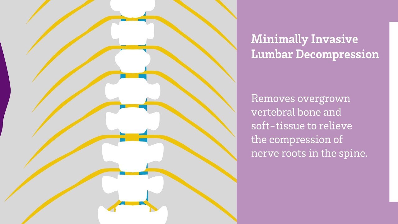 TrinityTalk Edu | Minimally Invasive Lumbar Decompression - YouTube