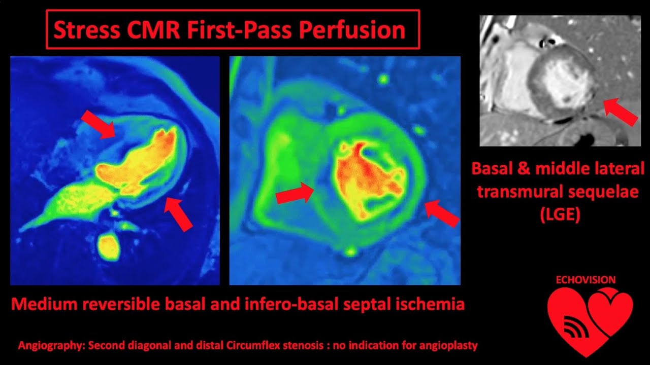 Stress CMR First Pass Perfusion - YouTube
