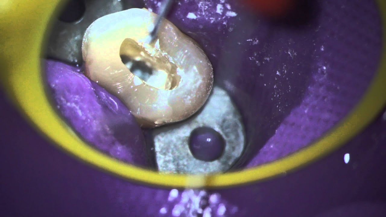 Backfill of Calcium Hydroxide in a root canal, video using a Seiler ...