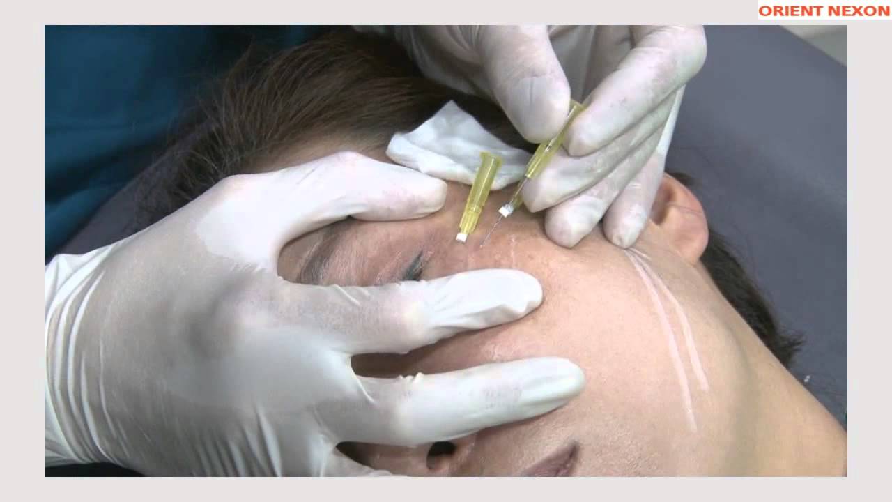 Orientnexon Surgery for Eyes Winkle - YouTube
