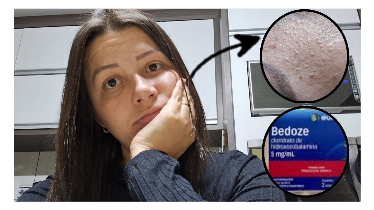VITAMINA B12 INJETÁVEL/ Acne , cravos e espinhas/ reações que tive ...