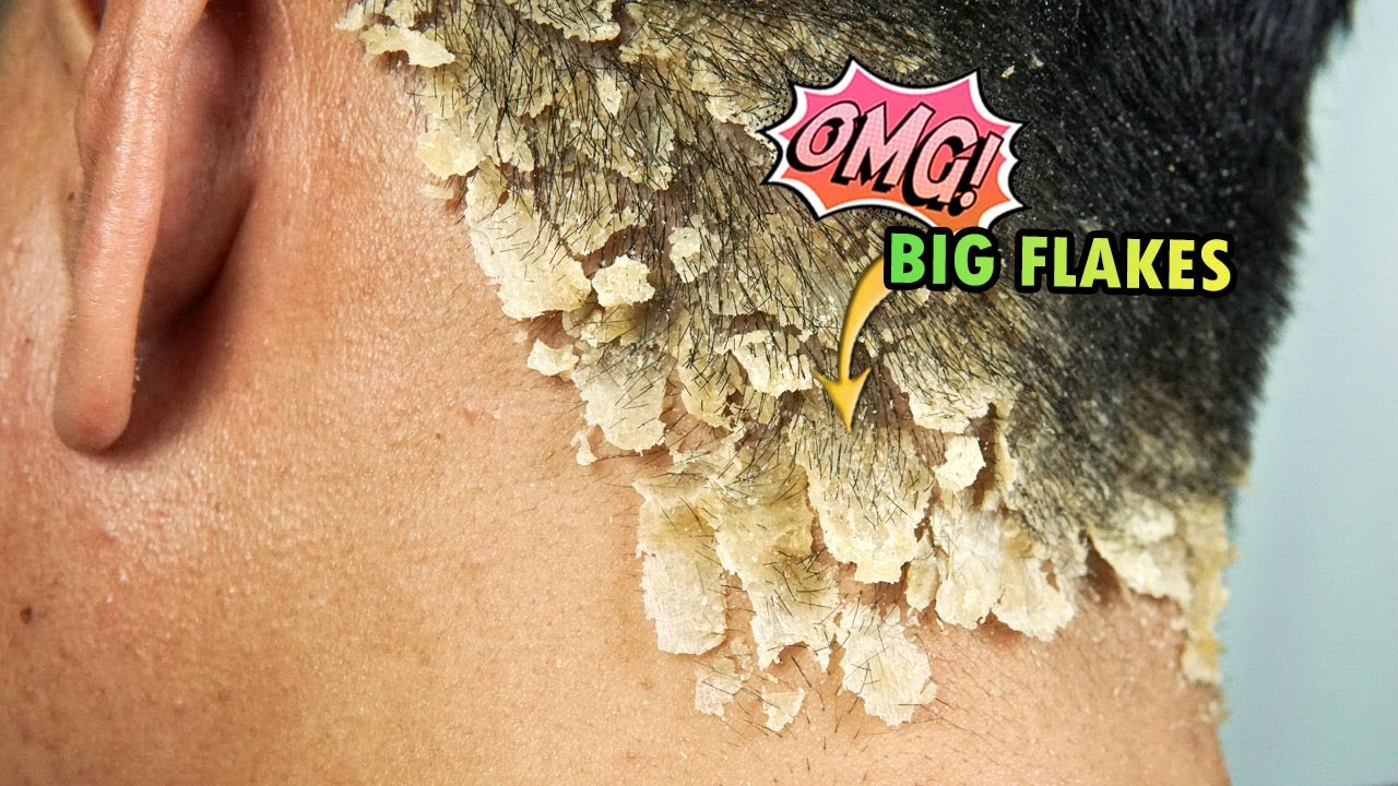 Huge Dandruff Flakes Removing and Picking #639 - YouTube