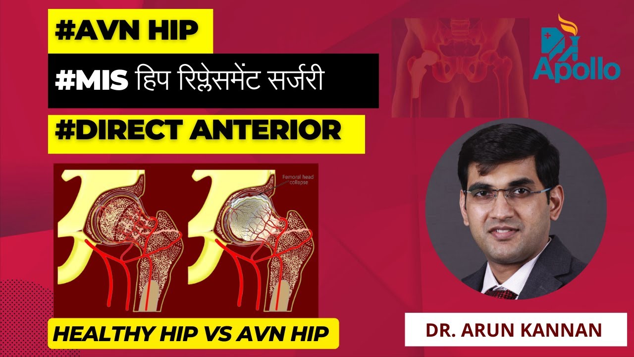 AVN I MIS Hip replacement I Direct Anterior I Bangladesh Patient I Dr ...