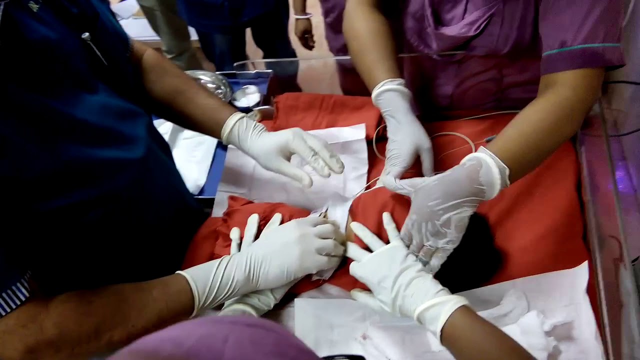 Exchange blood transfusion procedure - YouTube