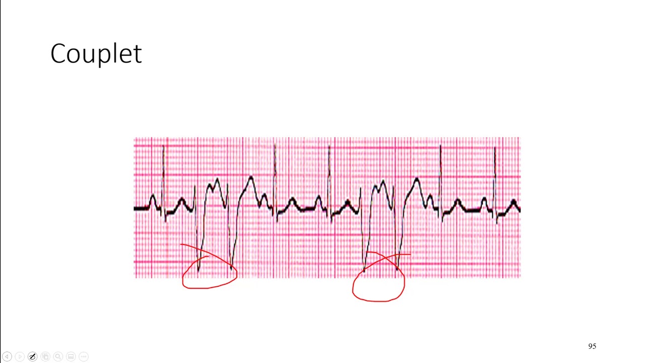 ECG 9: Ventricular Dys/Arrhythmias - YouTube