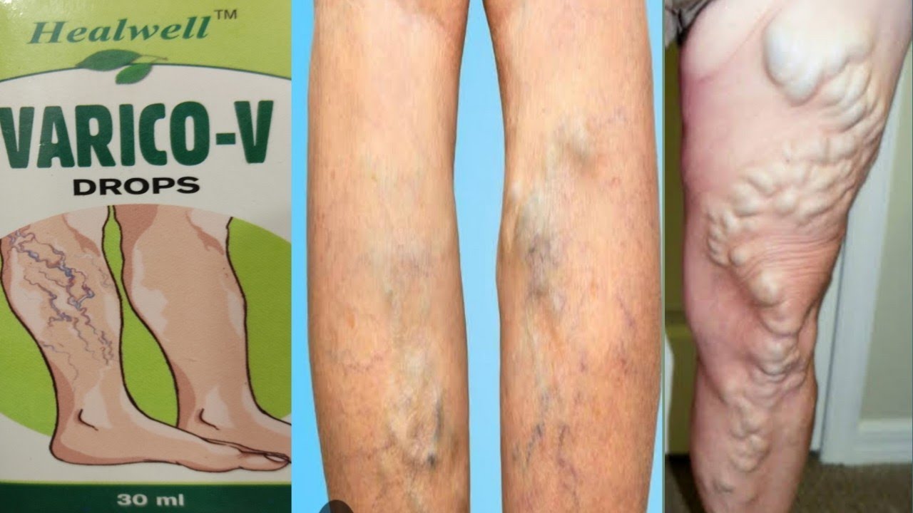 VARICO-V Drops | VARICOSE VEIN HINDI ME - YouTube