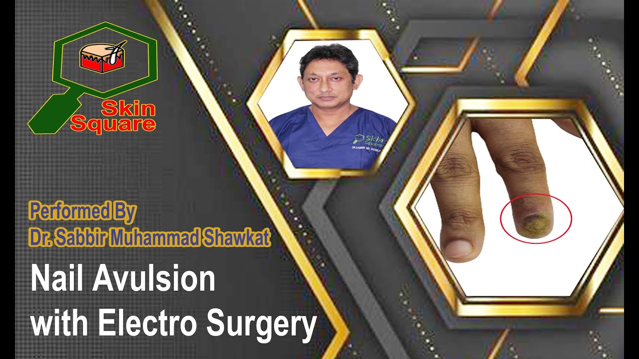 Nail Avulsion with Electro Surgery | Performed By Dr. Sabbir Muhammad ...