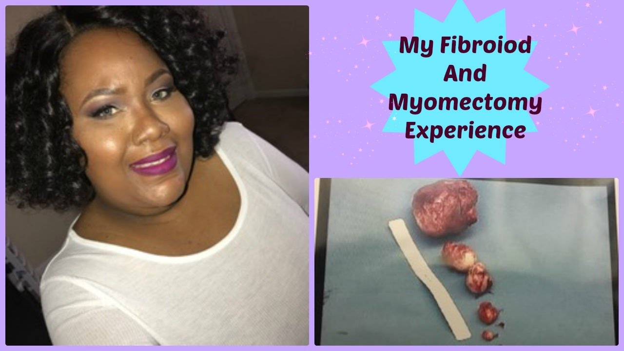My Fibroid and Myomectomy Experience - YouTube