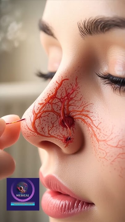 Why You Get Nosebleeds: Common Reasons - YouTube