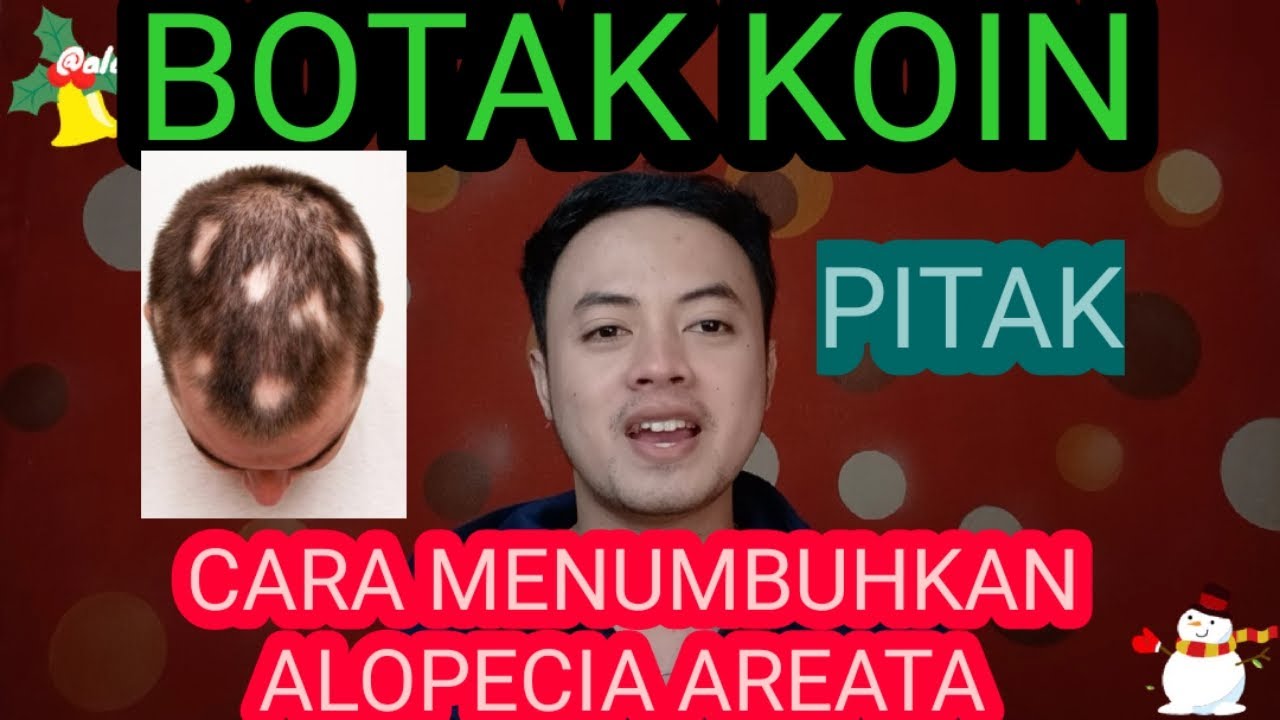 ALOPECIA AREATA - BOTAK KOIN - PITAK - CARA MENUMBUHKAN BOTAK KOIN ...
