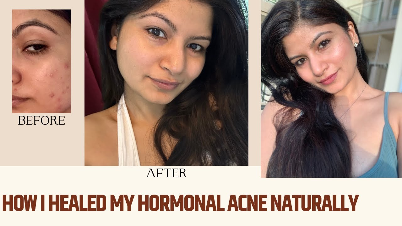 How I Healed My Hormonal Acne Without Isotretinoin I My Journey Of