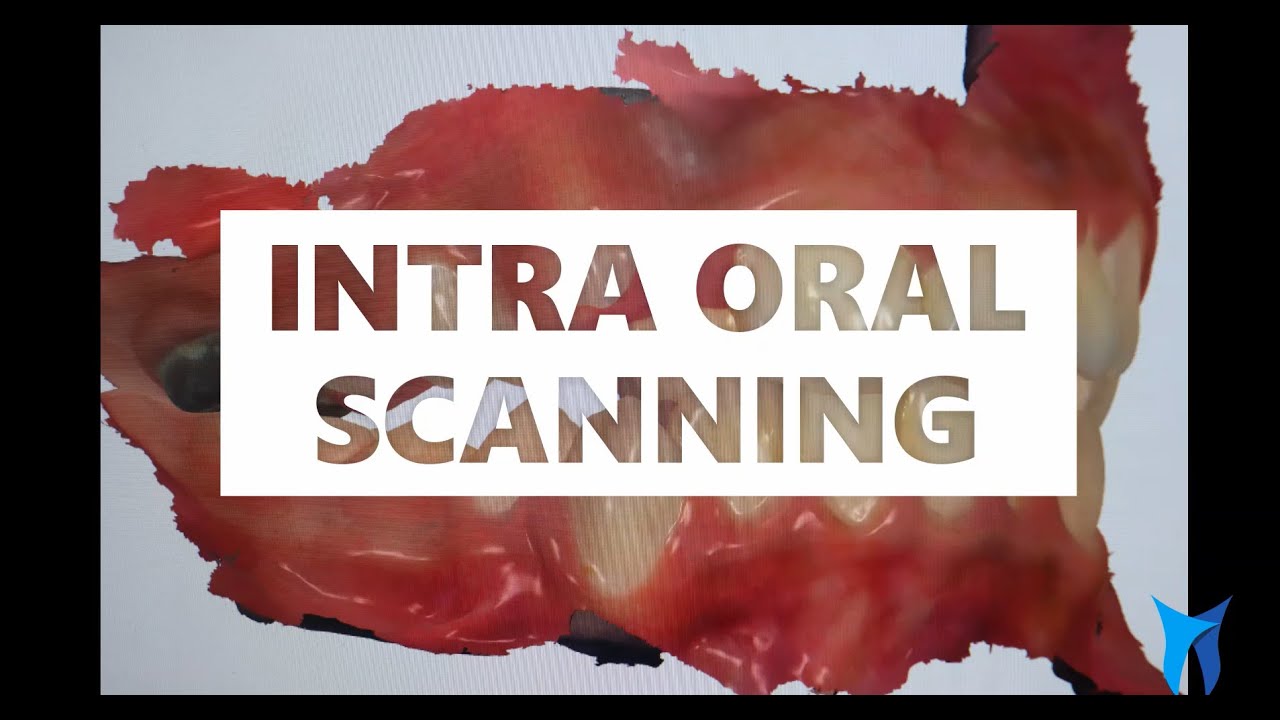 Intra Oral Scan | Digital Dental Impression | Role of Intra Oral ...