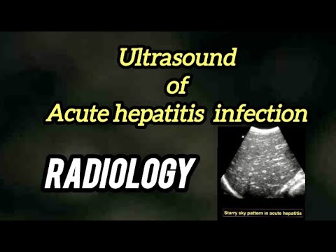 Acute Hepatitis - Ultrasound Scan # Radiology - YouTube