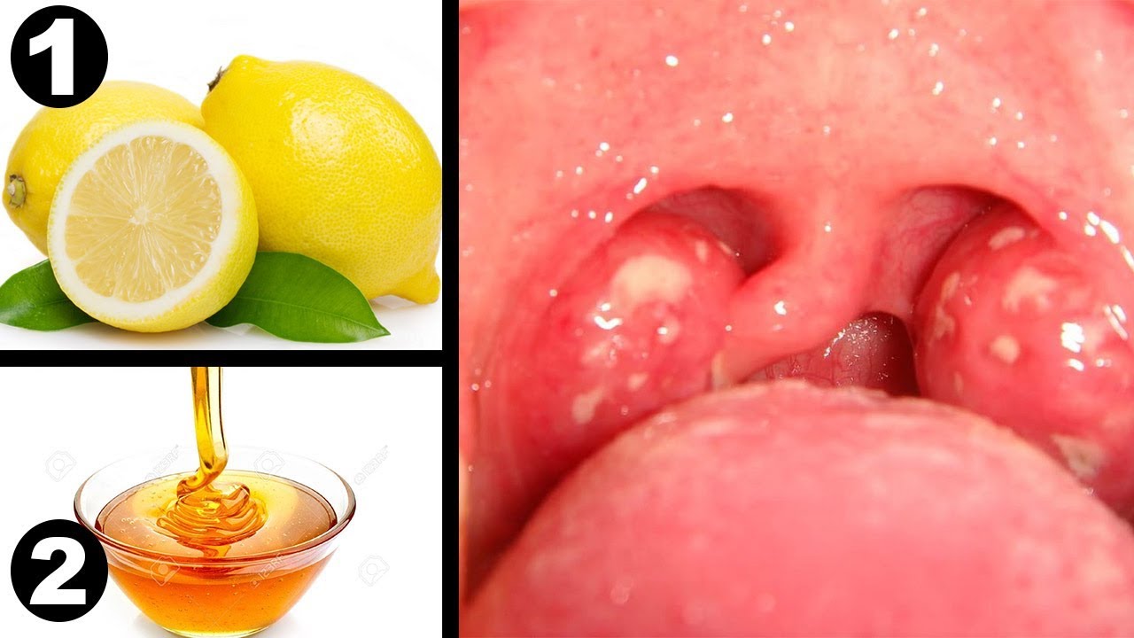 Remedios Muy Efectivos Para Amígdalas Inflamadas, Como Desinflamar ...
