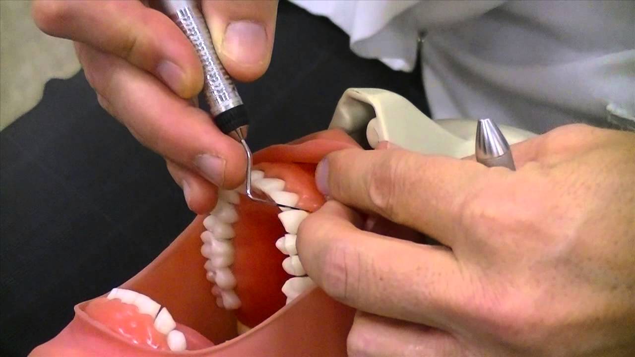 Probe Facial Maxillary Anteriors - YouTube