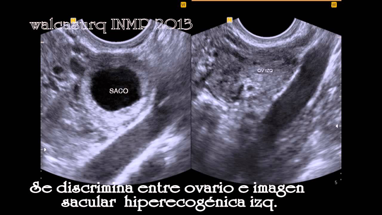 Embarazo ectópico tubárico izquierdo - YouTube