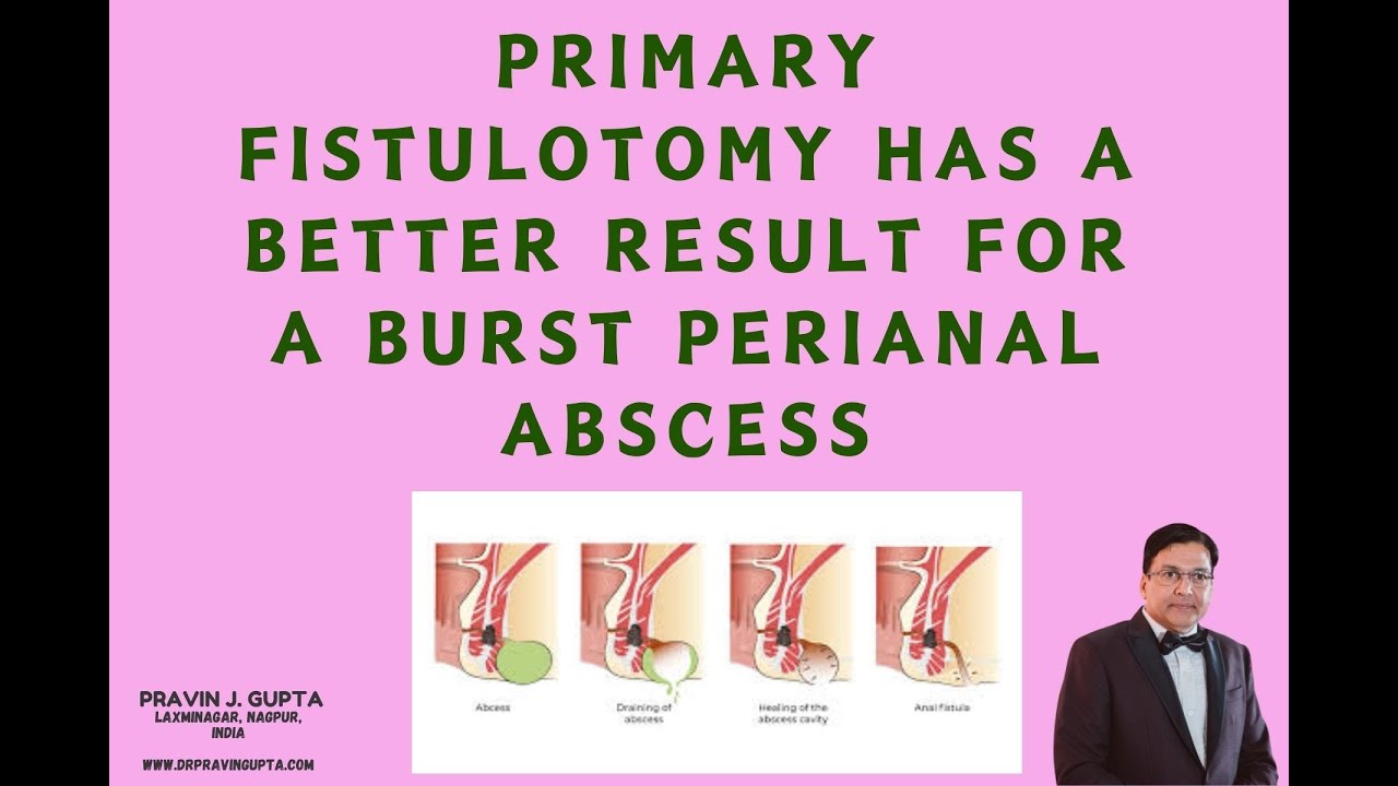 DOING FISTULOTOMY FOLLOWING A BURST PERIANAL ABSCESS - YouTube