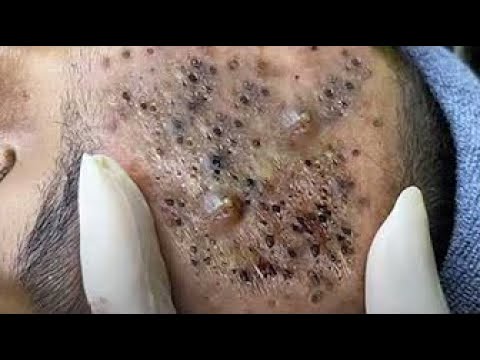 BEST Pimple Popping // Big Cystic Acne Blackheads // Whiteheads Removal ...