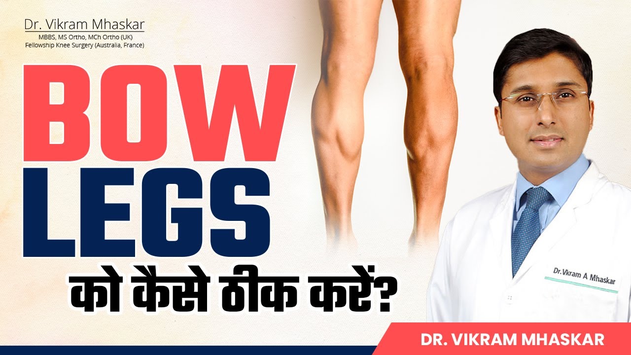 Bow Legs Correction: Bow Legs को कैसे ठीक करें? | Bow Legs Treatment ...