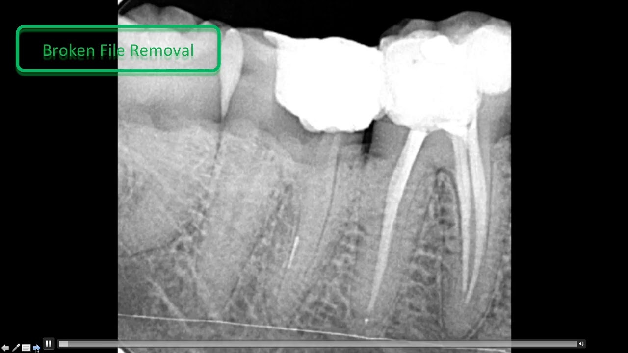 Clinical Strategies for Broken File Retrieval - YouTube