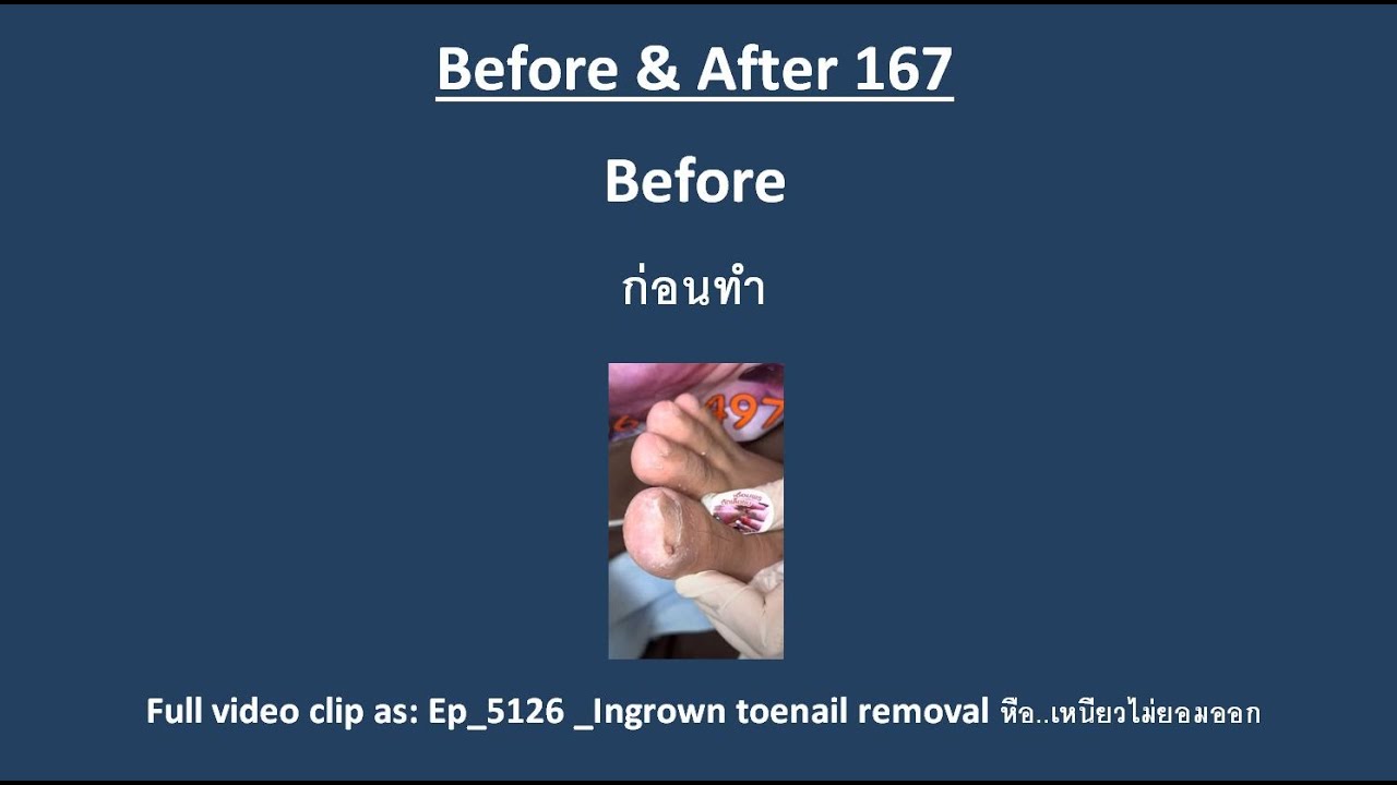 BA_167 Before and After 👣 มาดูแผลเล็บขบหลังจากน้องมาทำกับพี่เอื้อม 😷 ...