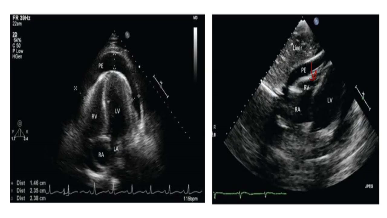 Lecture 6: Focused ECHO for Assessment of Pericardial Effusion - YouTube