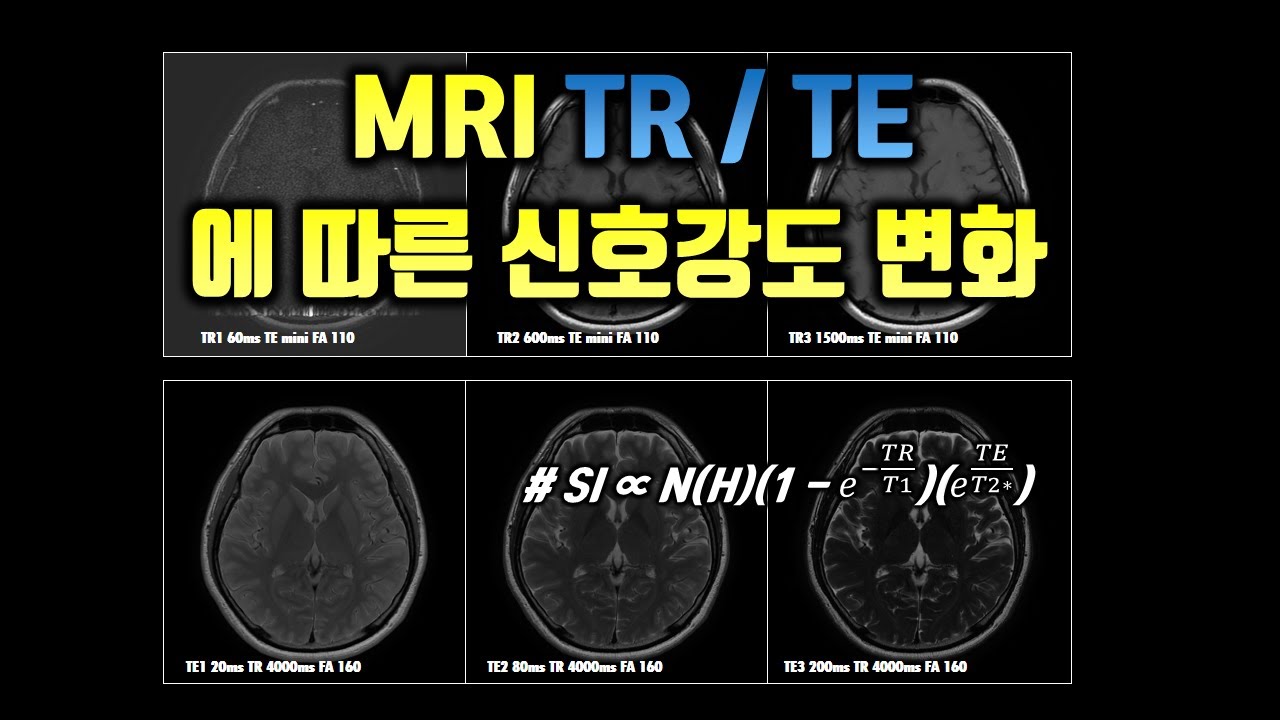 MRI TR , TE 설정에 따른 신호 강도 변화 #자기공명영상 #MRI #MR파라메터 #MR신호 - YouTube