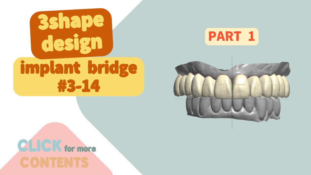 3shape design temporary implant bridge #3-14 - YouTube