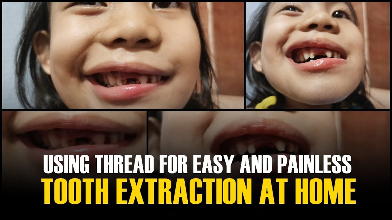 Using Thread for Easy and Painless Tooth Extraction at home - YouTube