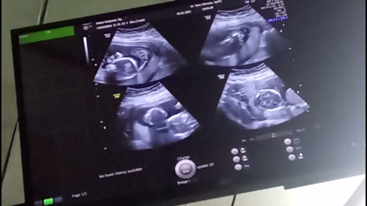 usg bayi kembar.. #bayikembar #usg # - YouTube